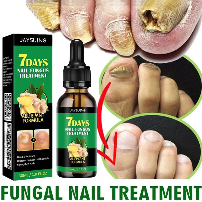 Nail Fungus Treatment - Daily Solution for Brittle & Thickened Nails ...