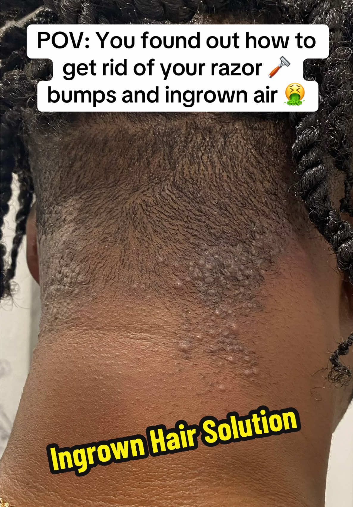 This has helped my razor bumps and ingrown hair over the past few weeks ...