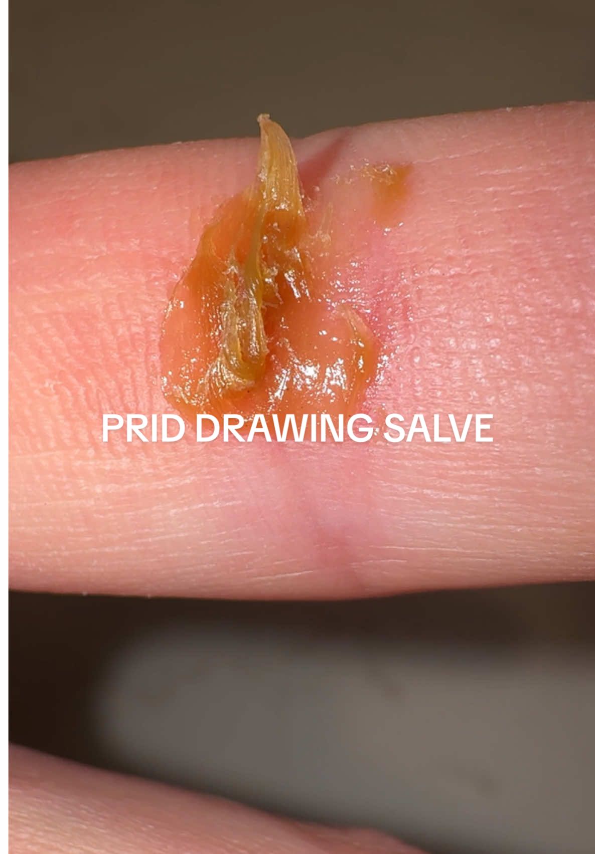 Replying to @Briar🐥 this PRID worked wonders on this splinter! 🤯 It ...